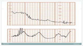Intrapartum fetal monitoring | PDF