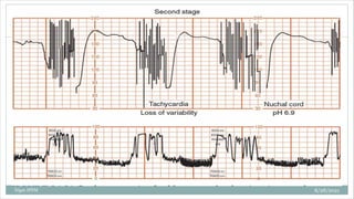 Intrapartum fetal monitoring | PDF