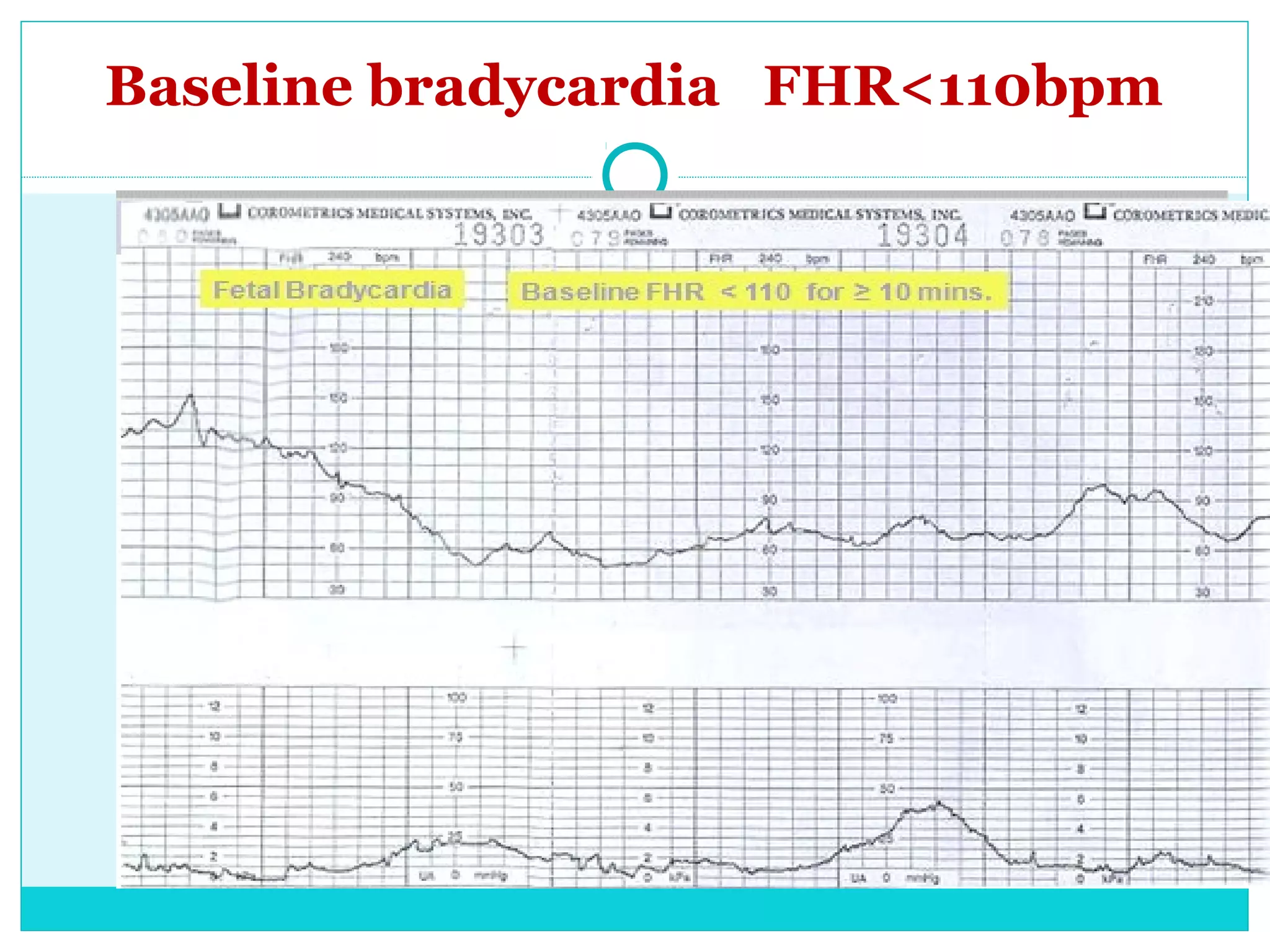 Intrapartum fetal monitoring for undergraduate | PPT