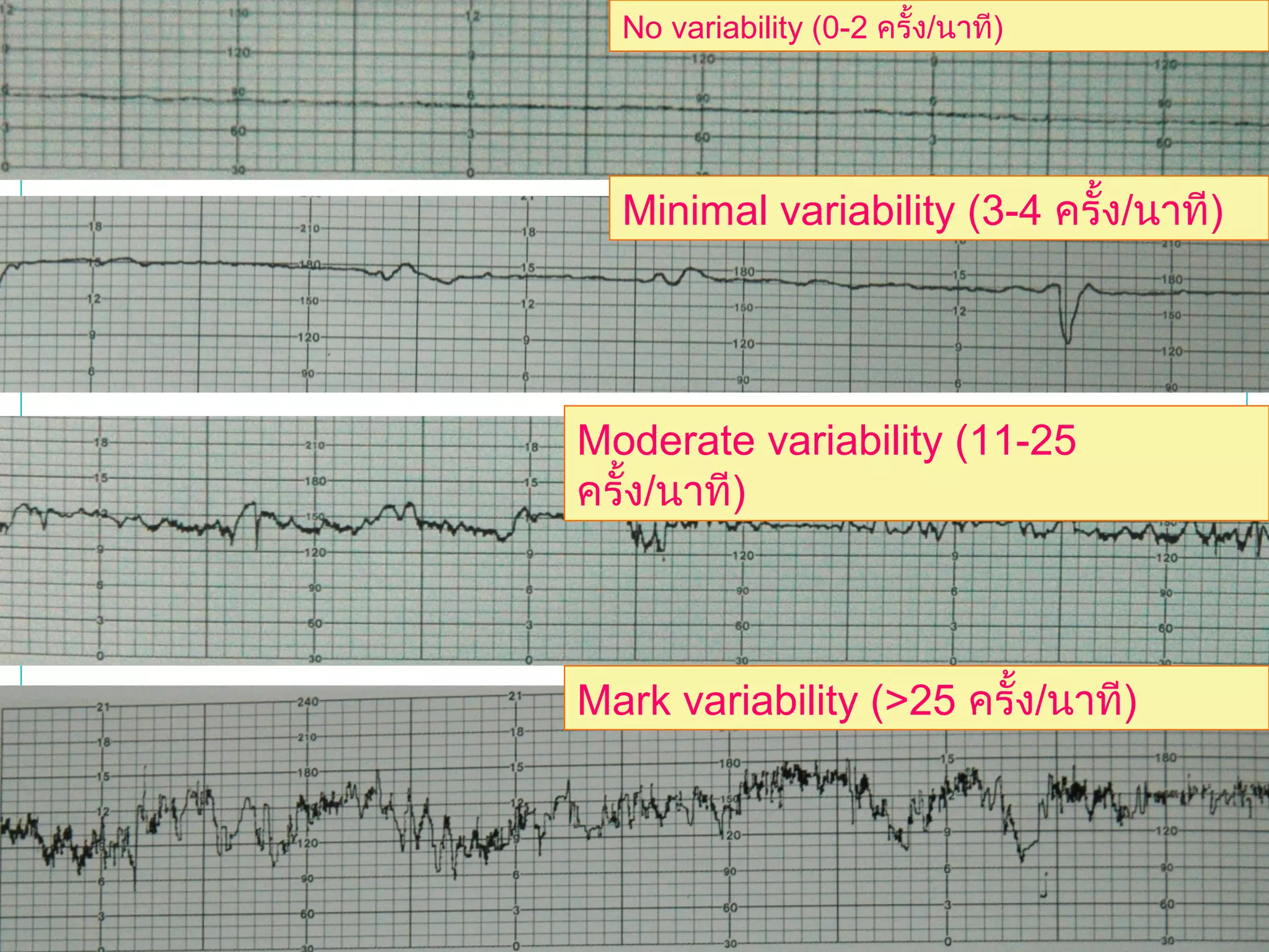 Intrapartum fetal monitoring for undergraduate | PPT