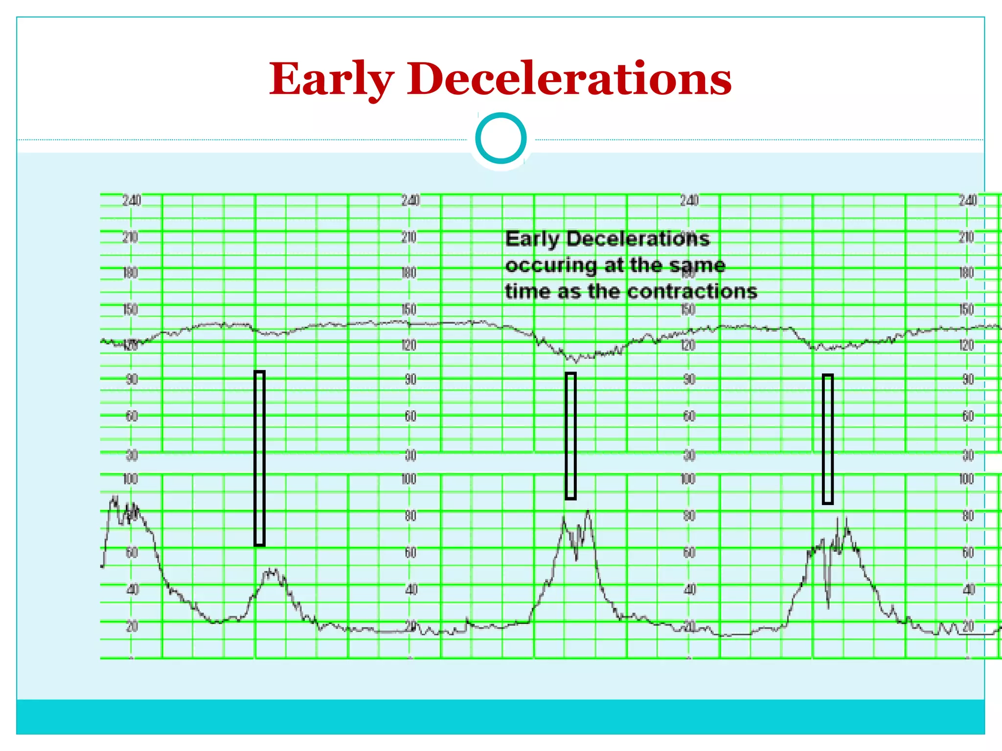 Intrapartum fetal monitoring for undergraduate | PPT