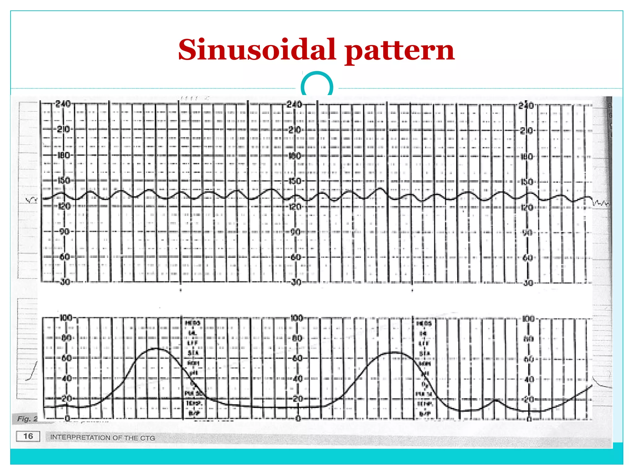 Intrapartum fetal monitoring for undergraduate | PPT