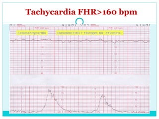 Intrapartum fetal monitoring for undergraduate | PPT