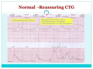 Intrapartum fetal monitoring for undergraduate | PPT