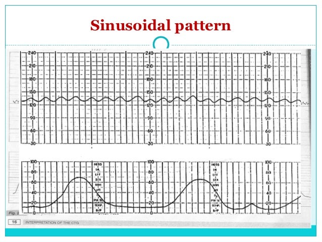 Intrapartum fetal monitoring for undergraduate