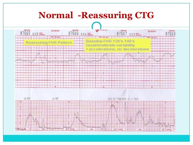 Intrapartum fetal monitoring for undergraduate