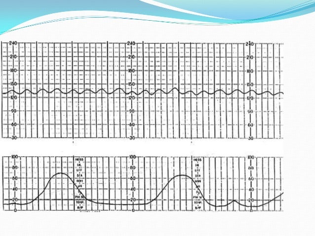 Intrapartum fetal survellence