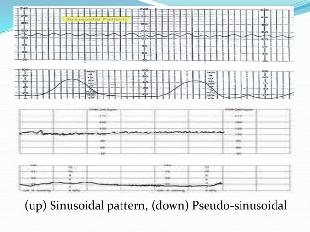 FOETUS Intrapartum monitoring27.4.12.pptx