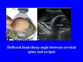 Intrapartum transperineal ultrasound.pptx