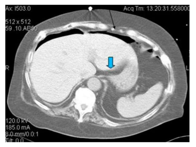 Intraperitoneal anatomy | PDF