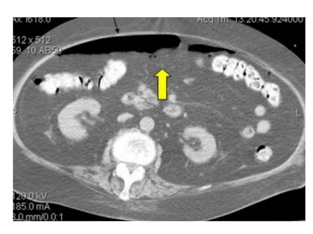 Intraperitoneal anatomy | PDF