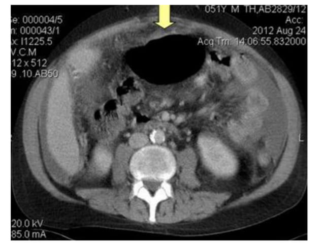 Intraperitoneal anatomy | PDF