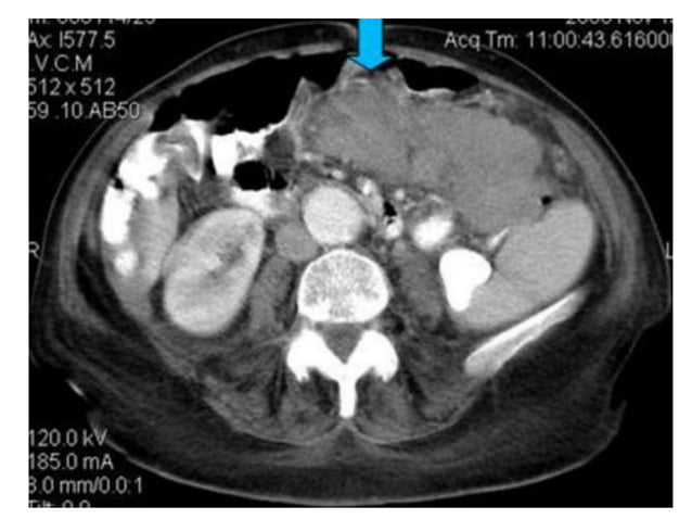 Intraperitoneal anatomy | PDF