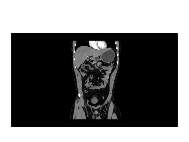 Intraperitoneal focal fat infarction | PPT