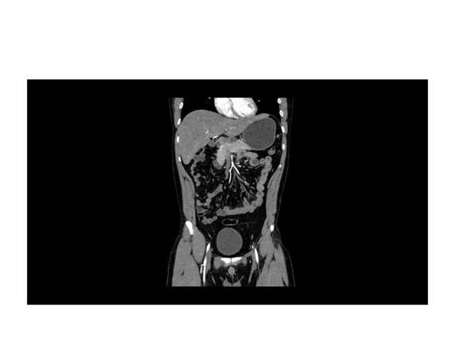 Intraperitoneal focal fat infarction | PPT