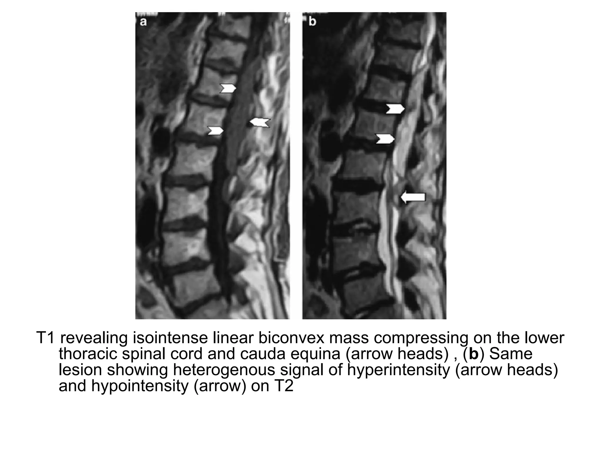 Diagnostic Imaging of Intraspinal Masses | PPT
