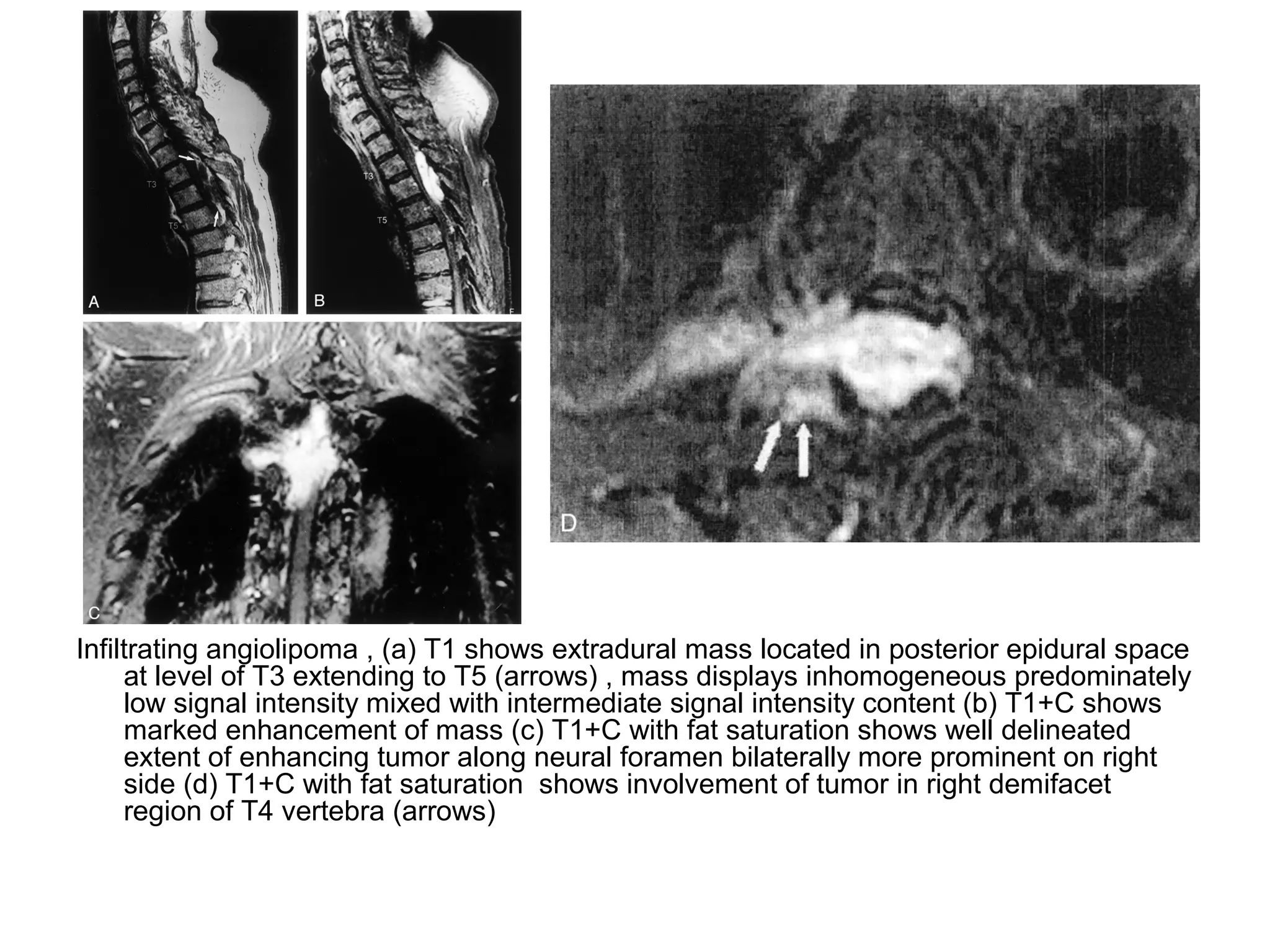 Diagnostic Imaging of Intraspinal Masses | PPT