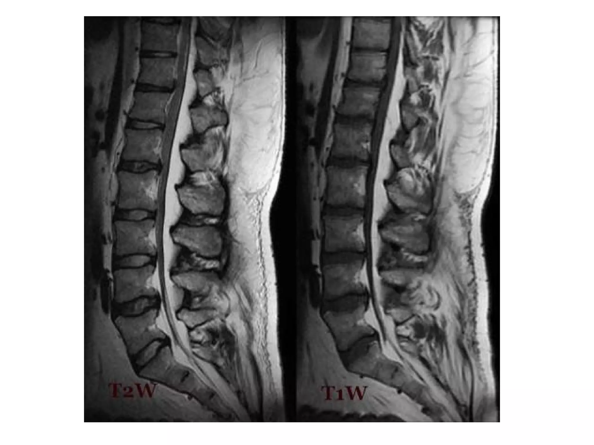 Diagnostic Imaging of Intraspinal Masses | PPT