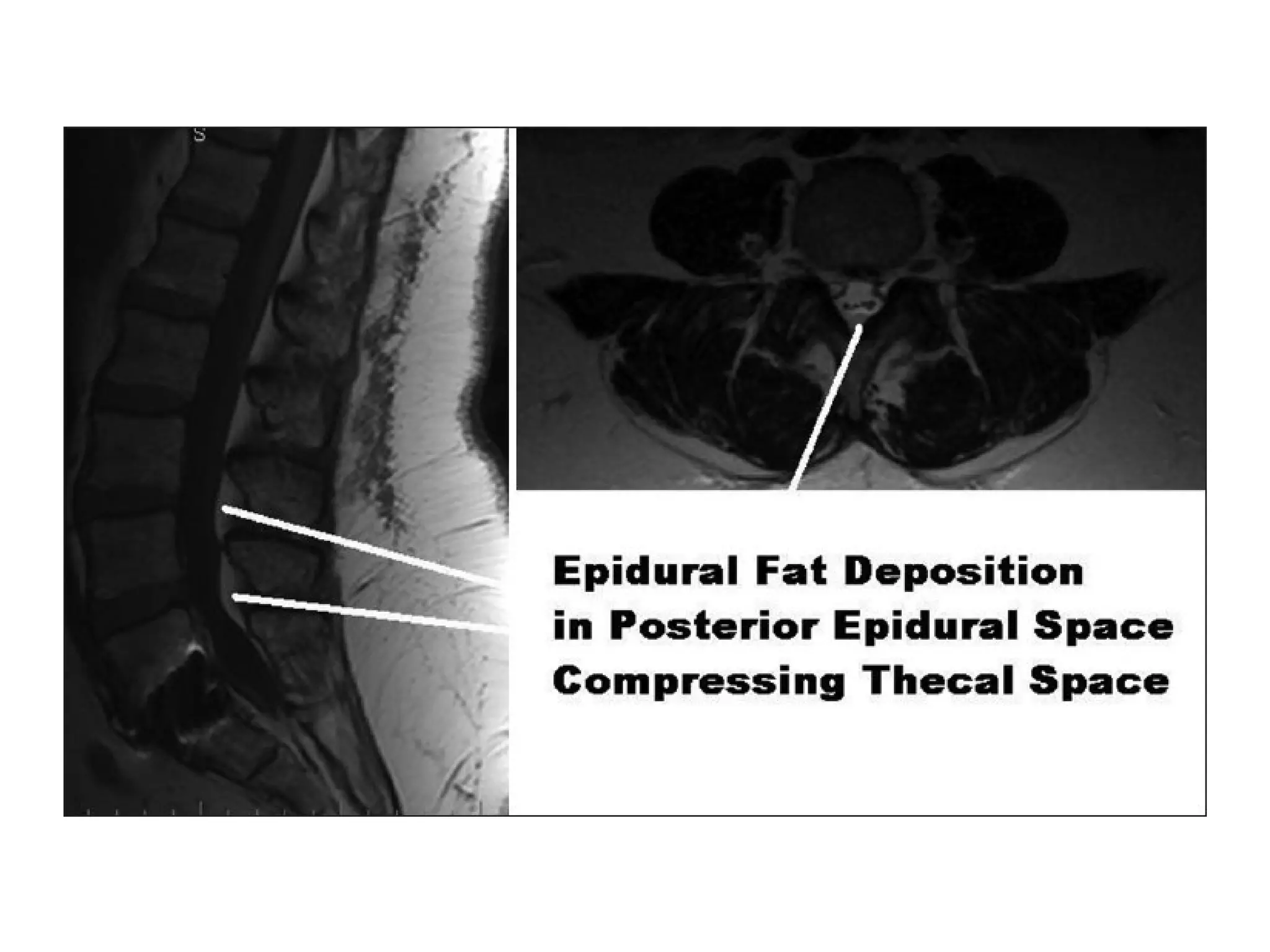 Diagnostic Imaging of Intraspinal Masses | PPT