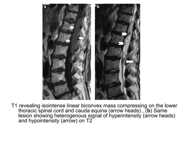 Diagnostic Imaging of Intraspinal Masses | PPT
