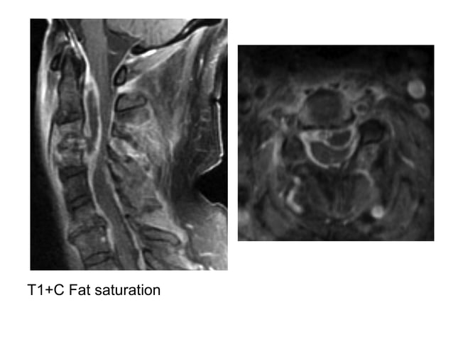 Diagnostic Imaging of Intraspinal Masses | PPT