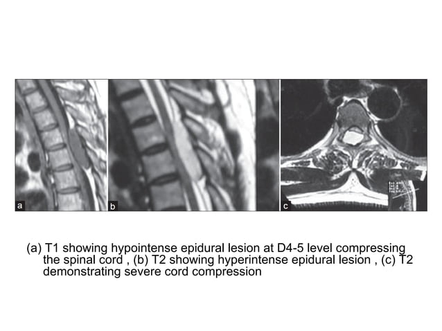 Diagnostic Imaging of Intraspinal Masses | PPT