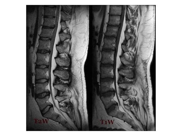 Diagnostic Imaging of Intraspinal Masses | PPT