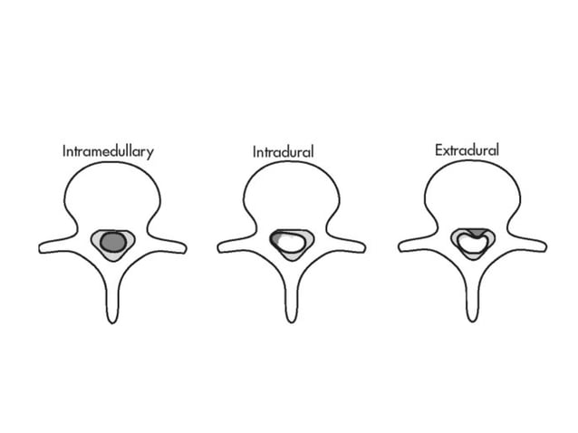Diagnostic Imaging of Intraspinal Masses | PPT