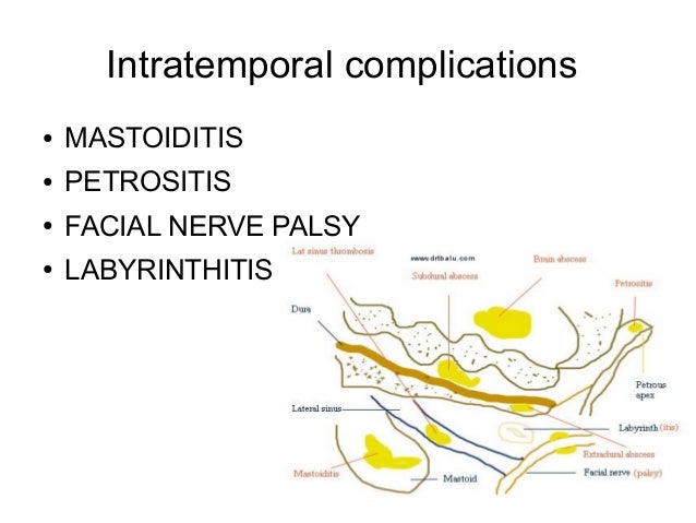 Intratemporal complications of otitis media