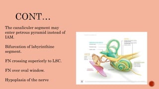 Intratemporal course of facial nerve | PPTX