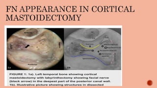 Intratemporal course of facial nerve | PPTX