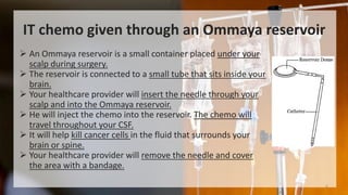 Intrathecal route for chemotherapy | PDF