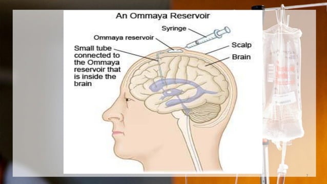 Intrathecal route for chemotherapy | PDF | Cancer | Diseases and Conditions