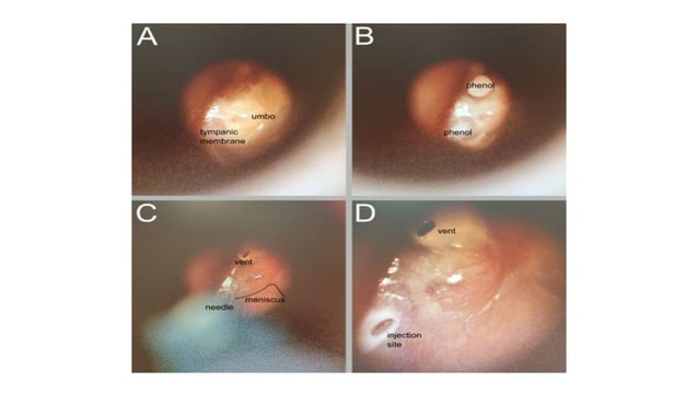 Intratympanic gentamicin injections | PPTX | Ear, Nose and Throat ...