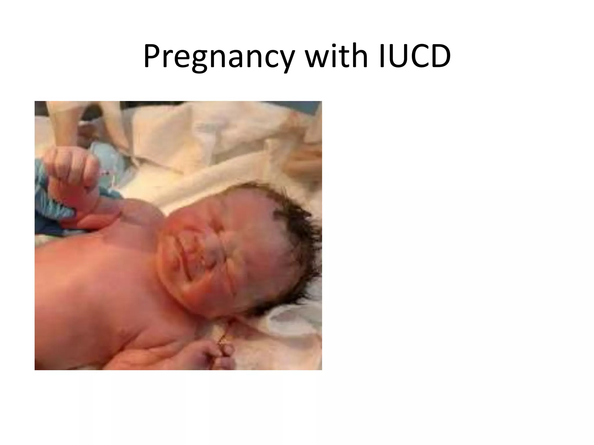 Intrauterine contraceptive device | PPTX