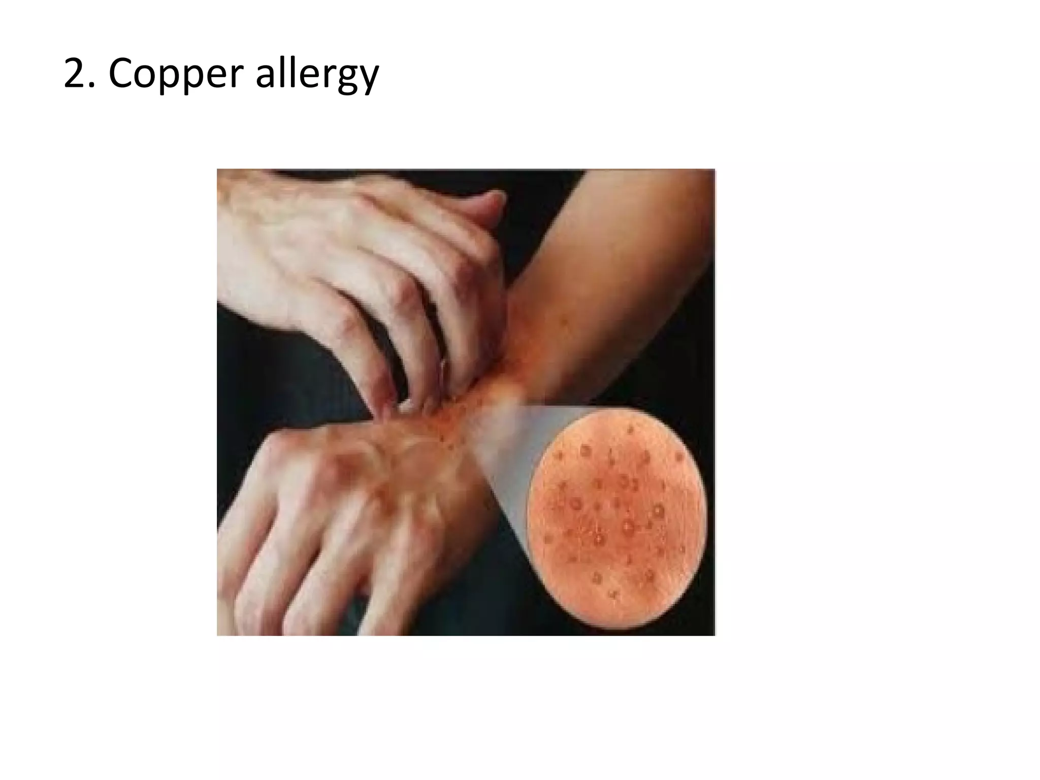 Intrauterine contraceptive devices ( IUCDs) | PPT