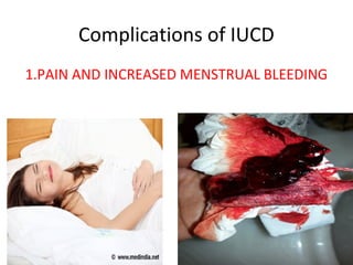 Intrauterine contraceptive devices ( IUCDs) | PPT