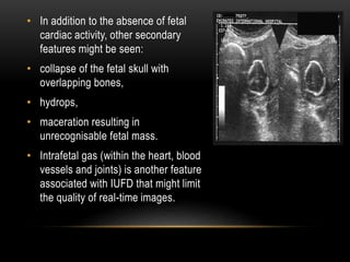 Intrauterine death | PPTX