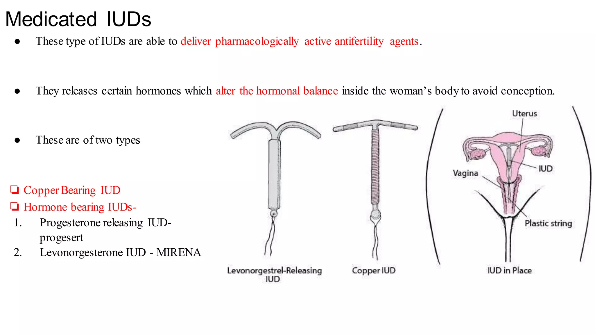 INTRAUTERINE DRUG DELIVERY SYSTEM.docx