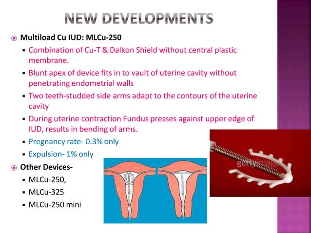 IntraUterine System (IUS) or IntraUterine Drug Delivery System (IUDDS ...