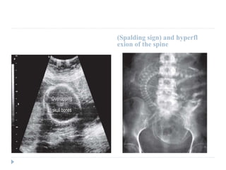INTRAUTERINE FETAL DEATH_1.pptx