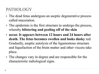 INTRAUTERINE FETAL DEATH_1.pptx