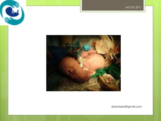 Intra uterine fetal surgery | PPT