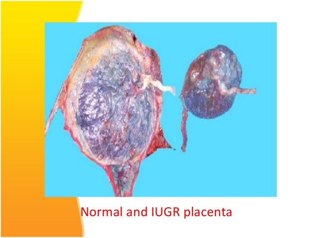 Intrauterine growth restriction