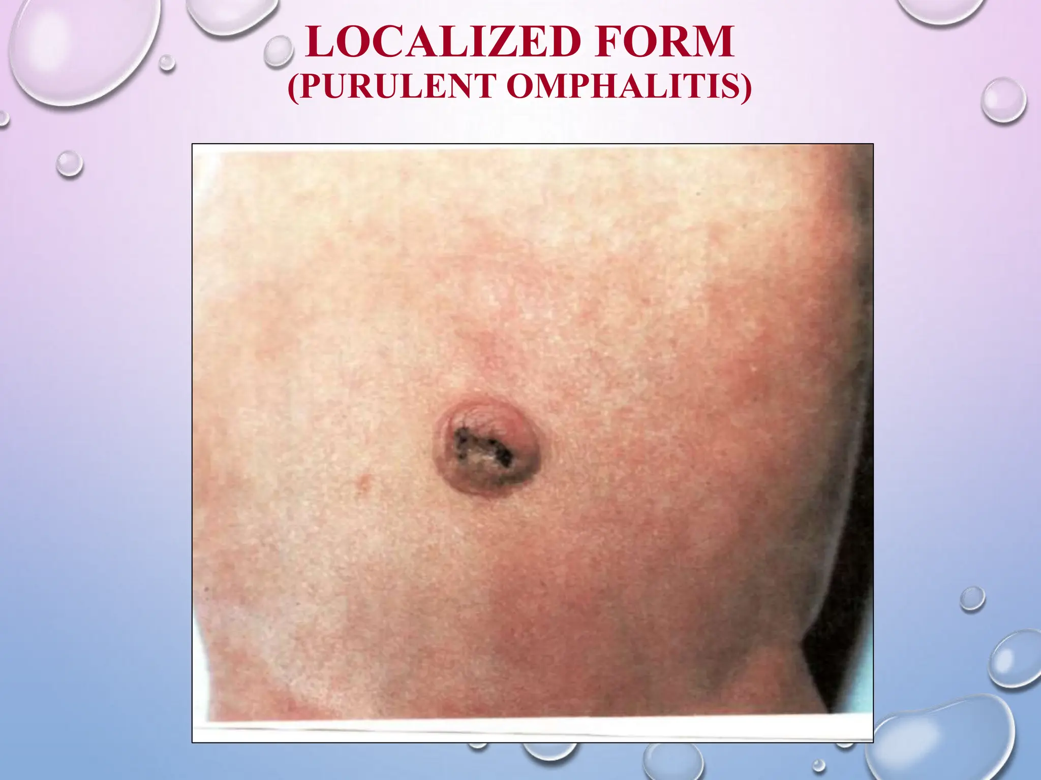 Intrauterine infection in a pregnant women.ppt