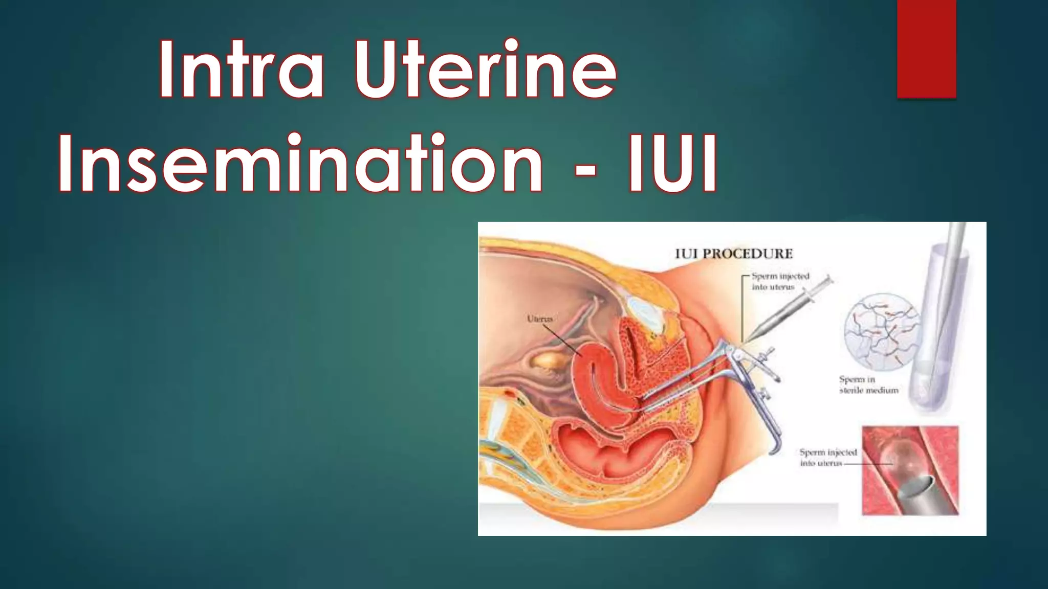 Intra uterine insemination iui | PPTX