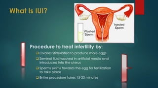 Intra uterine insemination iui