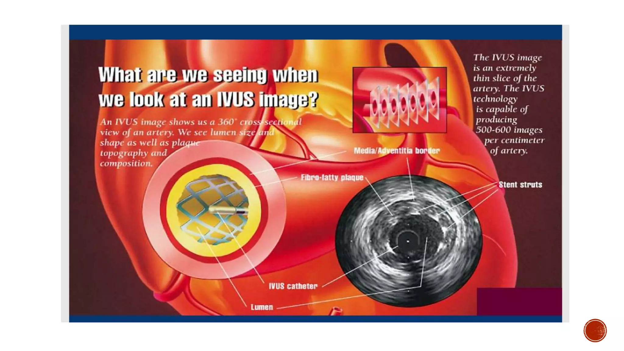 Intra Vascular Ultrasound | PPTX