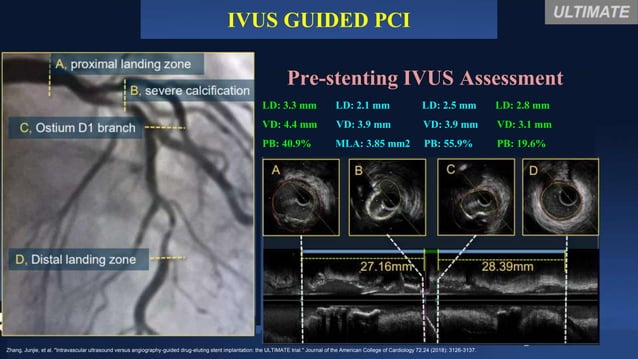 Intravascular Ultrasound Versus Angiography-Guided Drug-Eluting Stent ...