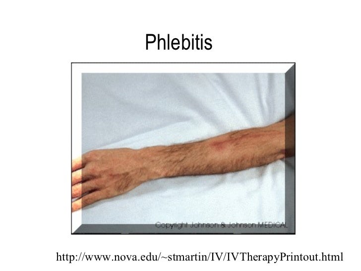 Intravenous cannulation